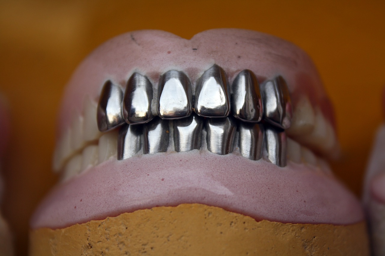 Plombages dentaires en amalgame - SEEKLINIK ZÜRICH - dentisterie